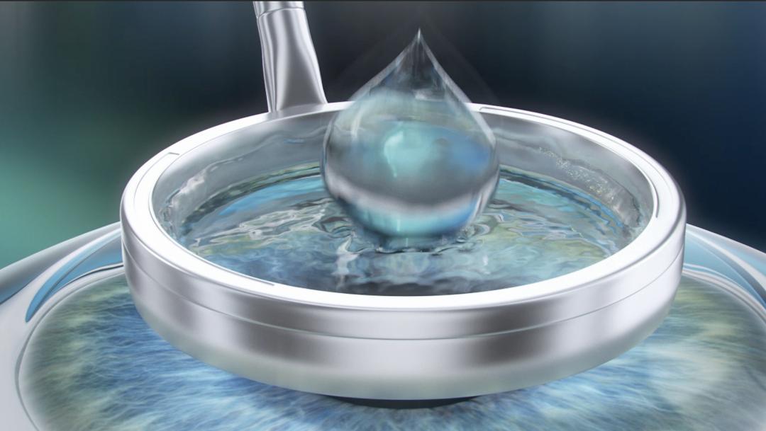 EK，TPRK是什么？准分子激光手术了解一下