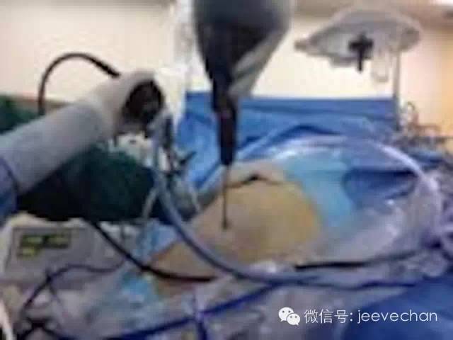 关节镜下全内缝合半月板