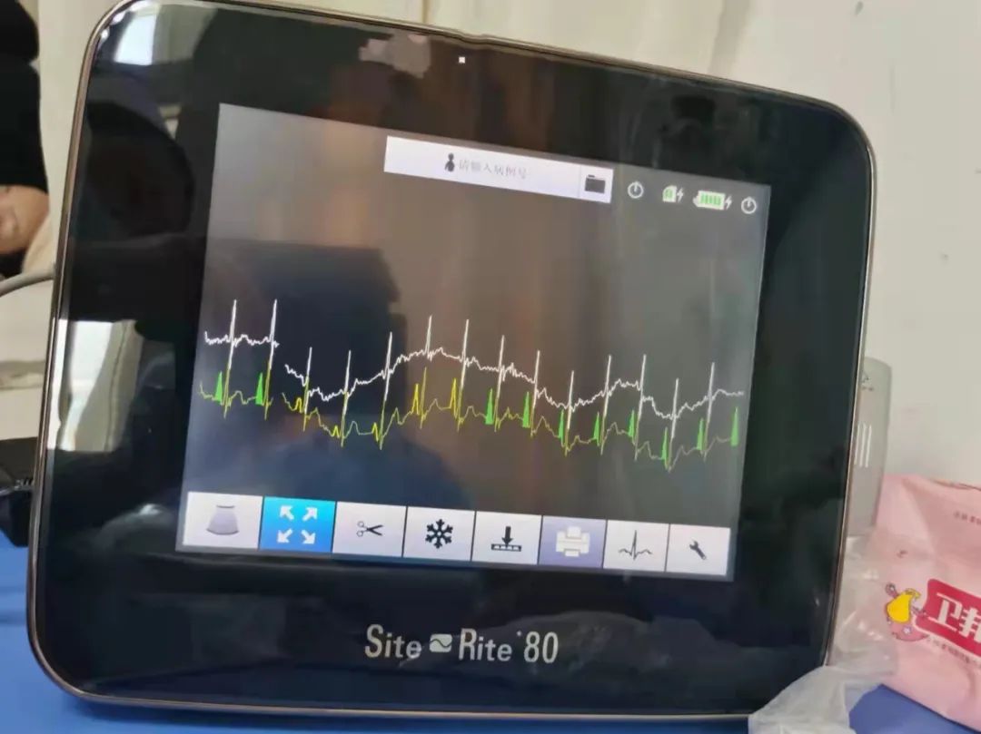 我院成功开展全市首例3CG尖端定位系统加隧道式PICC技术【技术新突破】