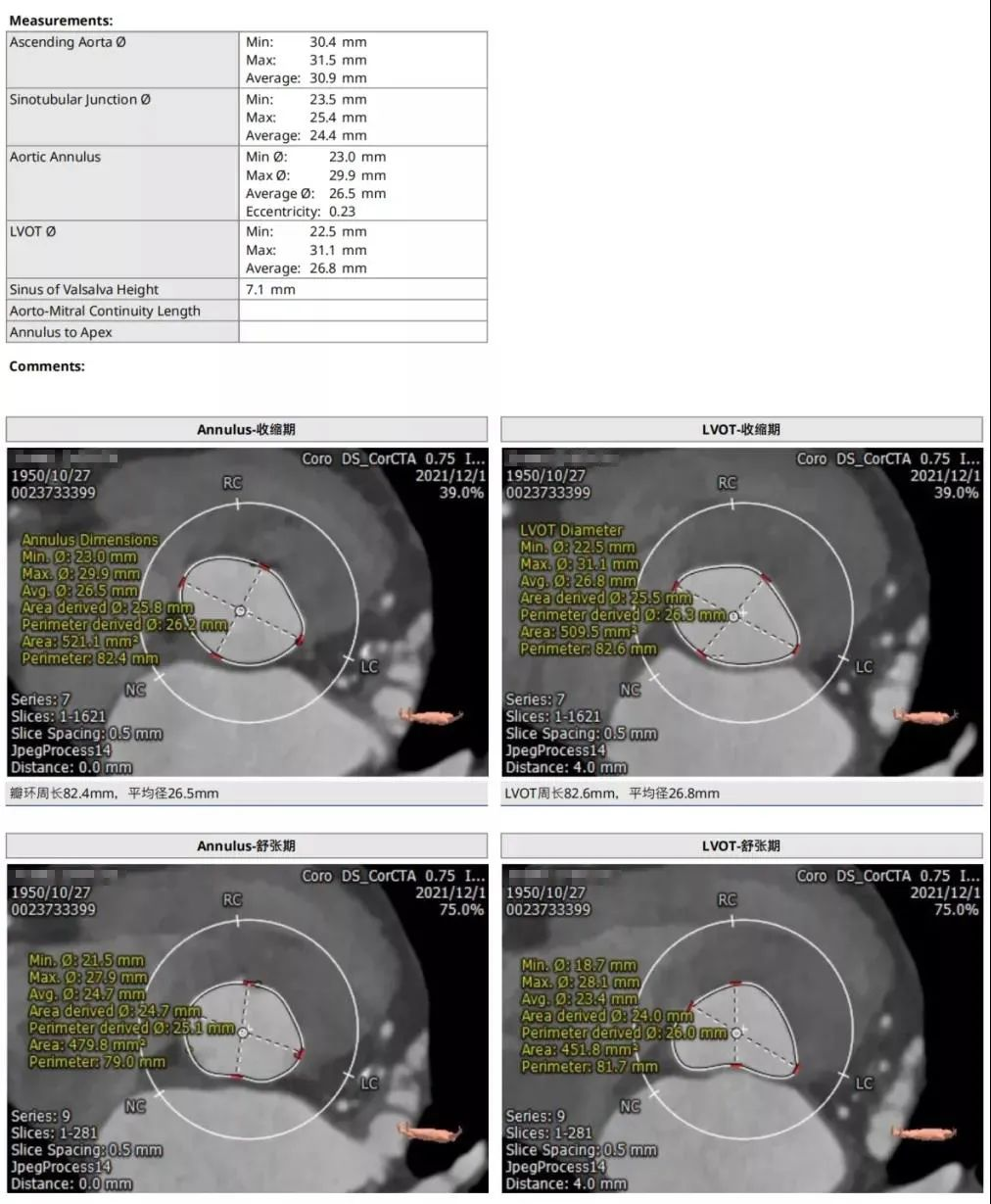 中国医大一院瓣膜介入团队应用VitaFlow Liberty™完成TAVR手术_澎湃号·政务_澎湃新闻-The Paper