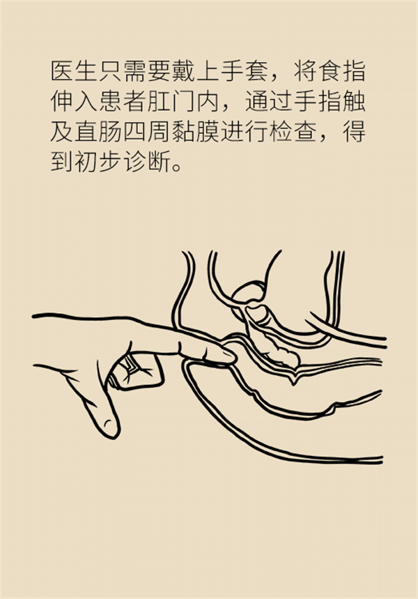 误把直肠癌当痔疮会致命！出现这七大症状要警惕澎湃号·政务澎湃新闻 The Paper