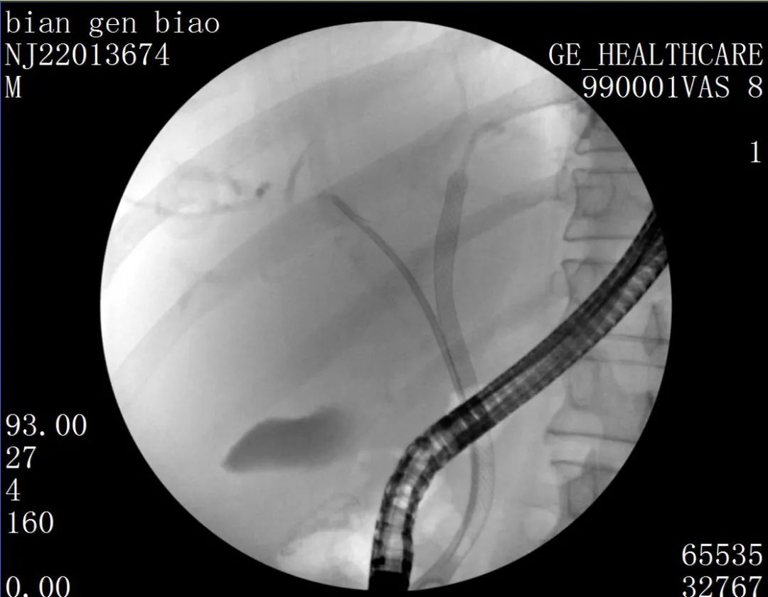 【病案现场】内镜诊治中心ERCP超选双支架内引流，破解梗阻性黄疸难题
