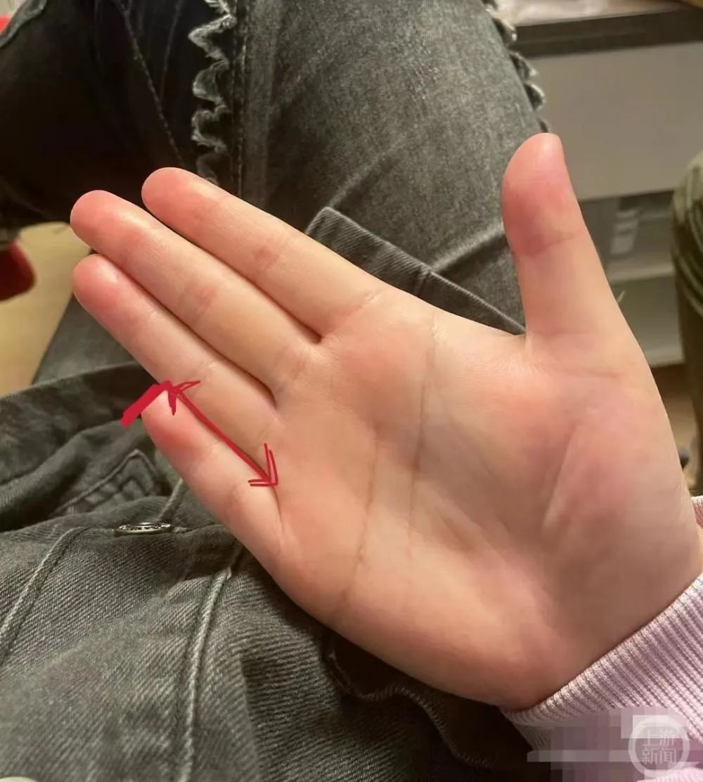 “短指症”上热搜，医生：三种手术可治疗_澎湃号·媒体_澎湃新闻-The Paper