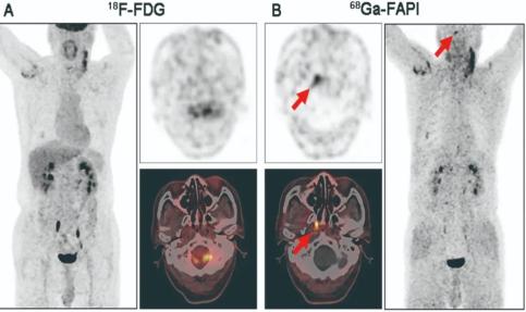 核医学分子影像探针加持的SPECT/PET/CT ,“点亮”肿瘤_澎湃号·湃客_澎湃新闻-The Paper