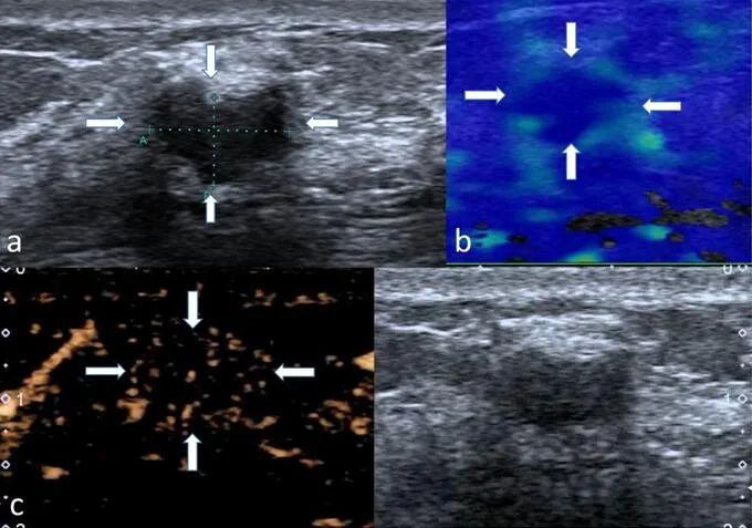 BI-RADS 4是“宣判”乳腺癌了吗_澎湃号·湃客_澎湃新闻-The Paper