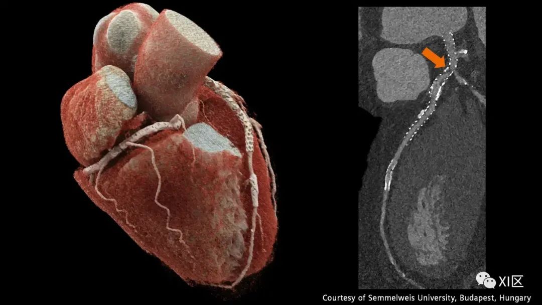 心脏CT的开花伪影_澎湃号·湃客_澎湃新闻-The Paper