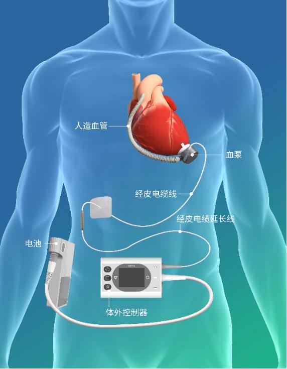 强势领跑！同心医疗人工心脏获FDA批准临床试验！