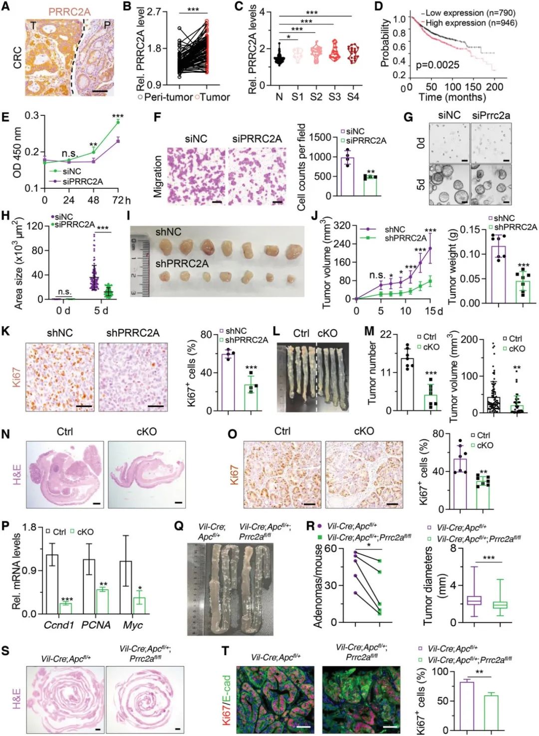 促进结直肠癌进展新机制，郑大一附院合作发文：发现结直肠癌治疗新靶点