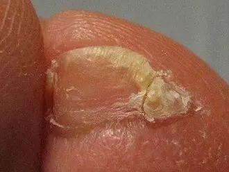 一个月时间指甲能长多长？为什么脚趾甲比手指甲长得慢？_澎湃号·湃客_澎湃新闻-The Paper