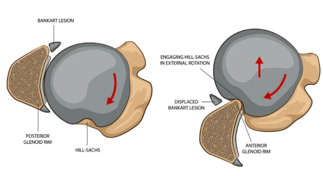 损伤防治：肩关节不稳定_澎湃号·湃客_澎湃新闻-The Paper