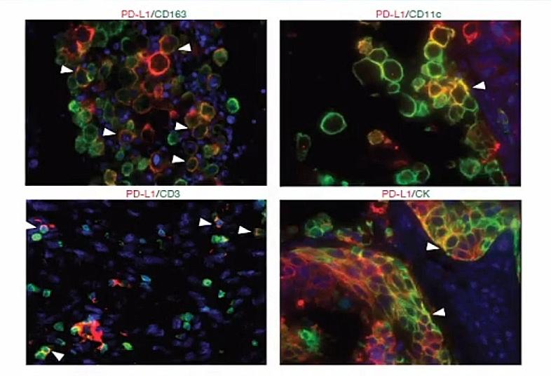 郑利民教授分享肝癌组织PD-L1的表达、调控与临床意义